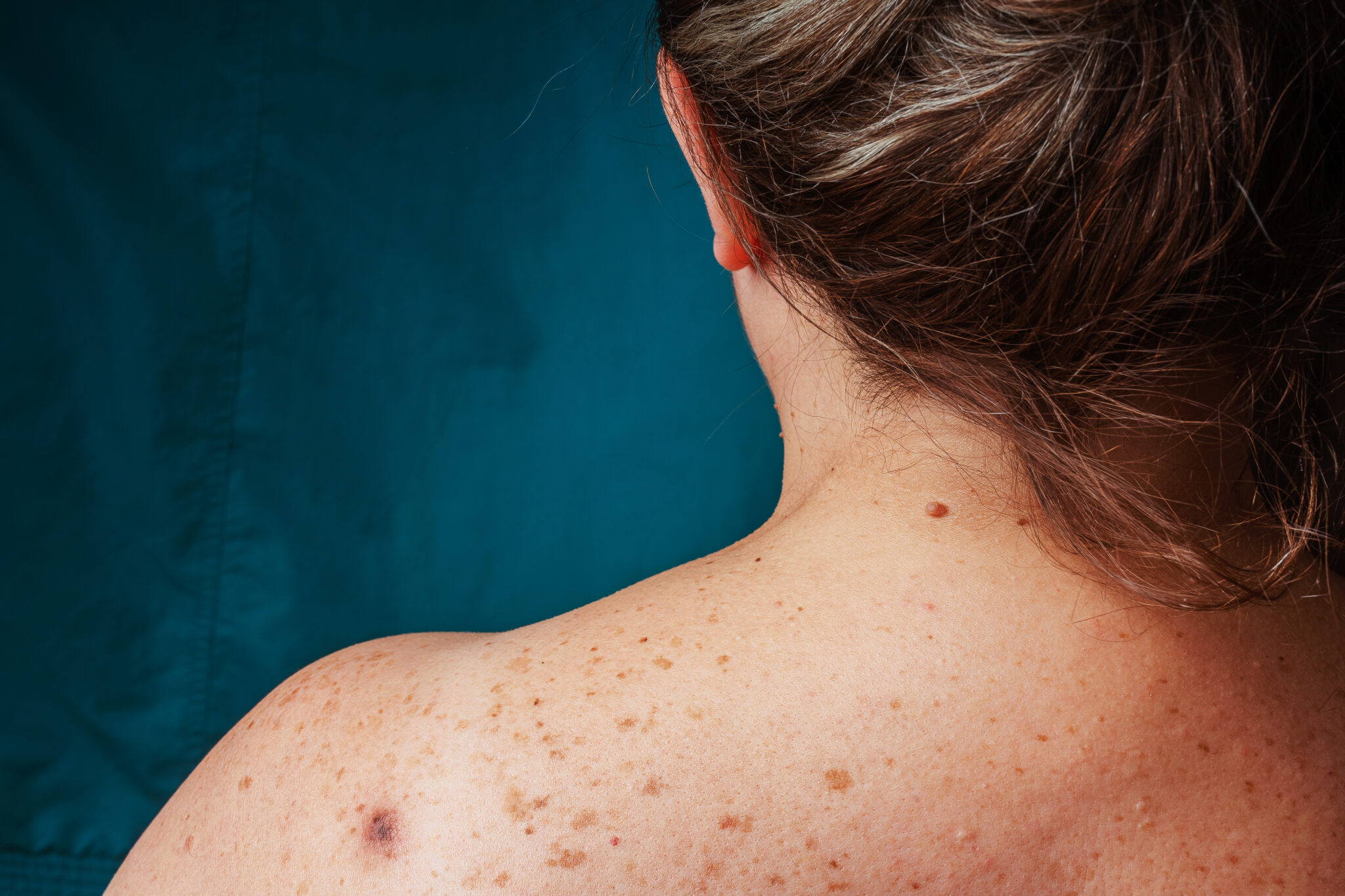 How to Get Rid of Age Bumps on the Face - The Menkes Clinic